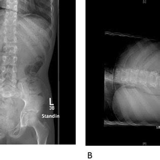 Right Lateral Decubitus Position