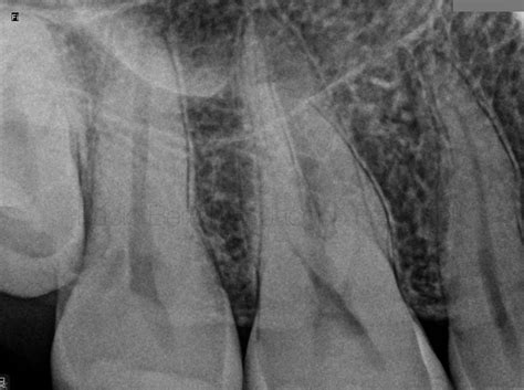 External Root Resorption Is Intentional Replantation A Real Option A Case Report Style