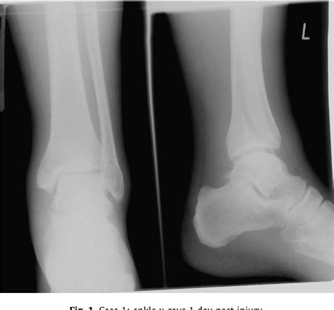 Distal Fibula Fracture
