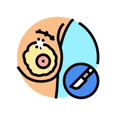 30 Lumpectomy Ilustrasi Grafik Vektor And Clip Art Bebas Royalti