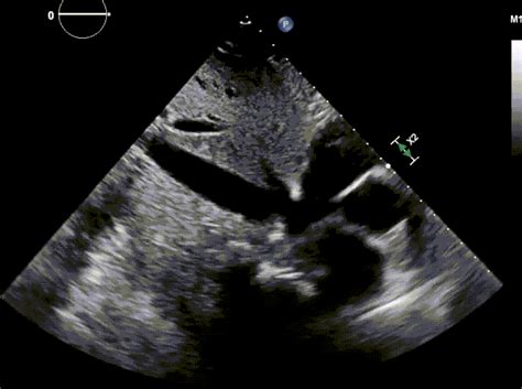 08 Fluid Responsiveness And Ivc Assessment