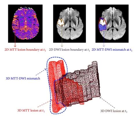 Mtt Dwi Mismatch At First Acquisition Acute Timepoint T 1 Top Row Download Scientific