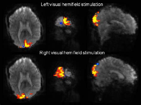 Results Of Visual Hemifield Experiment In Neurological Orientation The Download Scientific
