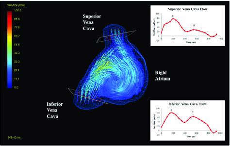 Streamline Visualization Velocity Encoded Of Typical Clockwise Download Scientific Diagram