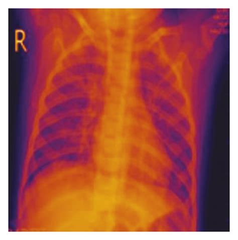 Wavelet Decomposition Images And Histograms Ad Ll Lh Hl And Hh
