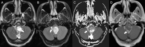 Brain Tumor Imaging In Adolescents And Young Adults 2021 Who Updates
