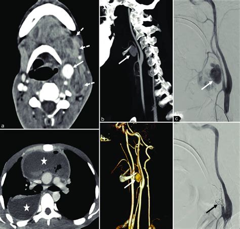 Ct Angiography A C And E Showing Lobular Pseudoaneurysm Arising From