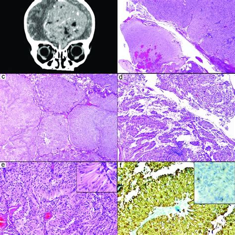 Clear Cell Ependymoma With Giant Cells A The Neoplastic Cells Are