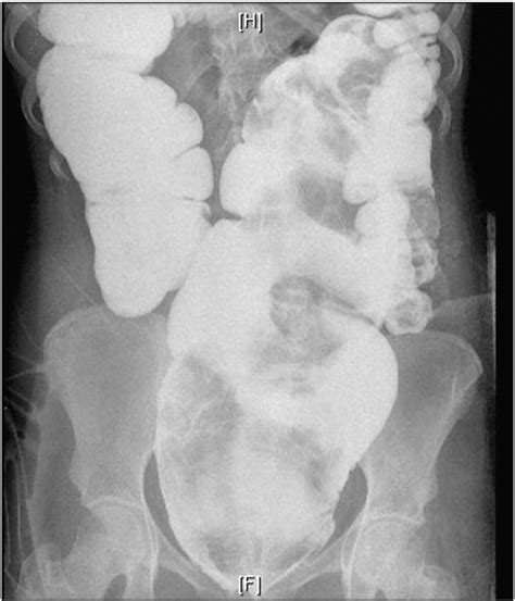Transanal Rectosigmoid Resection For Severe Intractable Idiopathic Constipation Journal Of