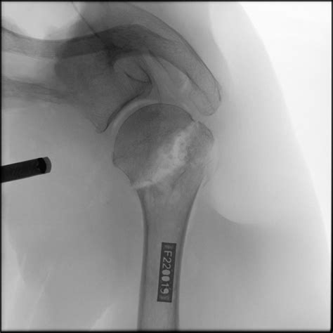 Fracture Of Proximal Humerus Left