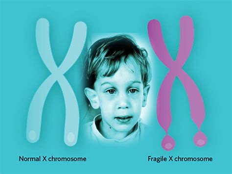 Fragile X Syndrome In Girls