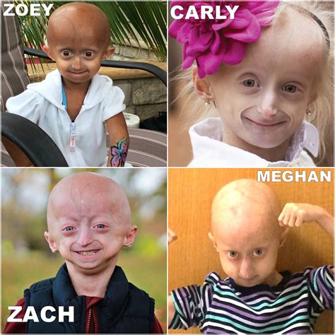 Progeria Adults