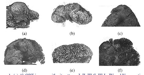 Figure 1 From Analysing The Surface Morphology Of Colorectal Polyps Differential Geometry And