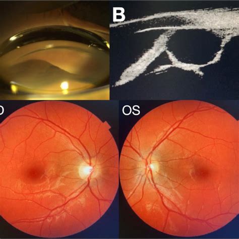 A Gonioscopic Findings Of Patient 1 Showing The Lumpy Bumpy