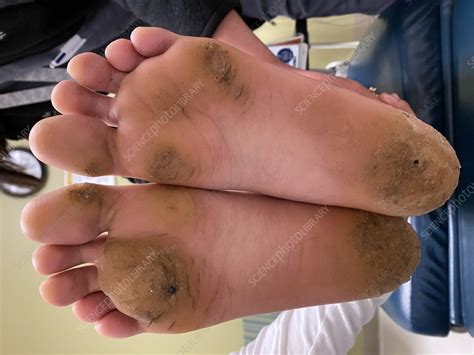 Plantar Keratoderma Stock Image C057 2186 Science Photo Library