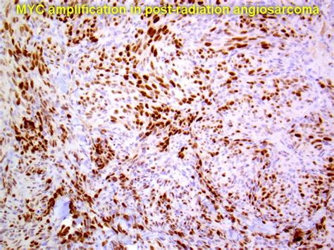 Angiosarcoma Molecular Genetics