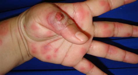 Erythema Multiforme Causes Types Symptoms Diagnosis And Treatment
