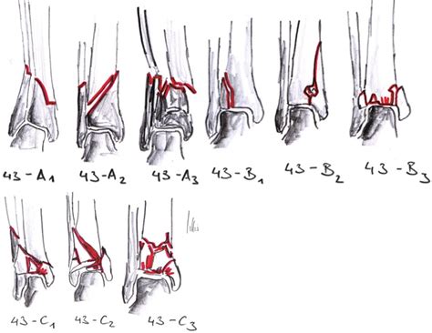 Tibial Pilon Fractures Classification Ankle Fracture