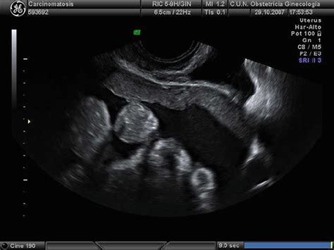 Transvaginal Ultrasound Showing Cancer Role Of Imaging In The