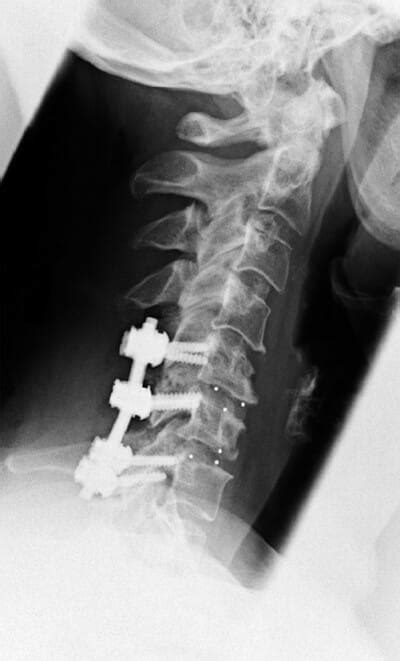 Prof Linhardt Fallbeispiel Fehlstellungen Und Spinalstenosen Der Hws
