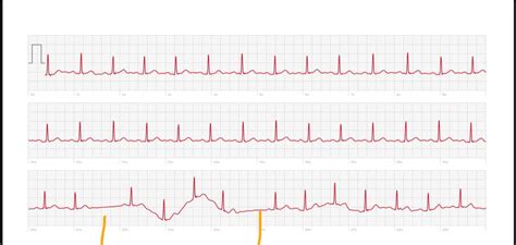 Sinus Pauses Or Non Conducted Pac Rreadmyecg
