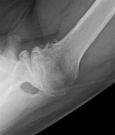 Orthobullets Axillary Lateral Shoulder Radiograph Shows End Stage Gh Oa With Large Osteophytes