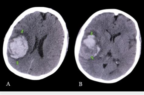 Axial Section Of The Computed Tomography Ct Scan A Predominantly