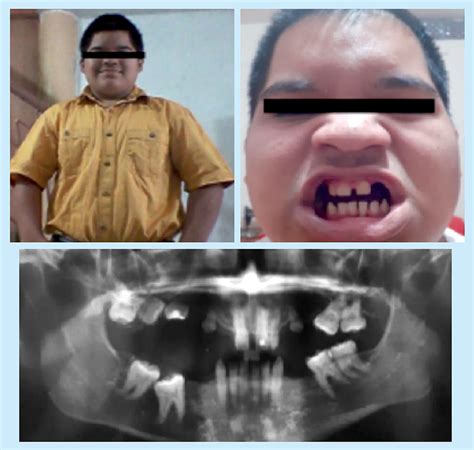 Pseudohypoparathyroidism Face