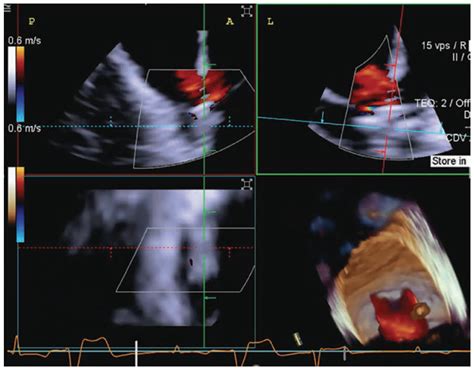 Tricuspid Teer With 4d Ice Guidance Cld