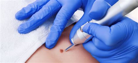 How To Remove Your Birthmarks The Natural Way Sk N Clinics