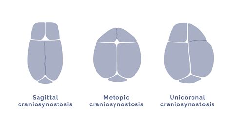 Craniosynostosis Condition Page London Orthotic Consultancy