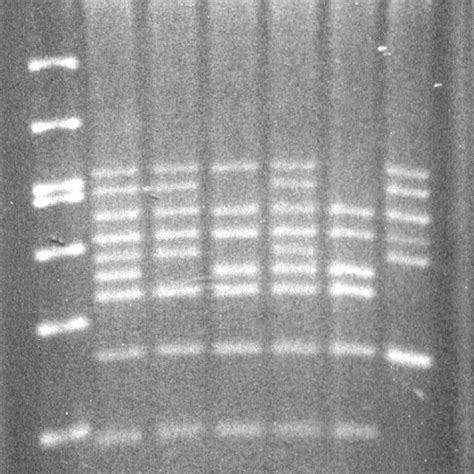 detection of the deletions by mpcr analysis set a exon 45 48 19