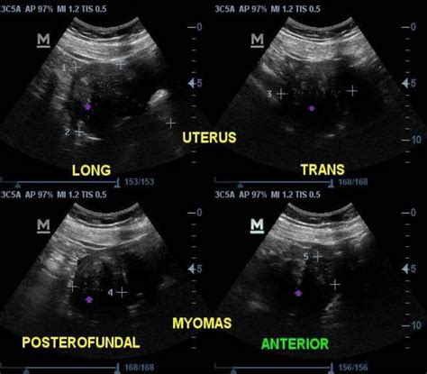 Transabdominal Sonograms Of The Uterus Showing A Heterogeneous But