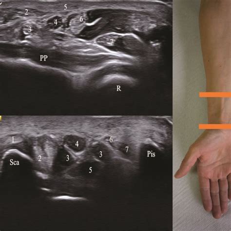 The Median Nerve Ultrasound In The Transverse Plane At Two Different