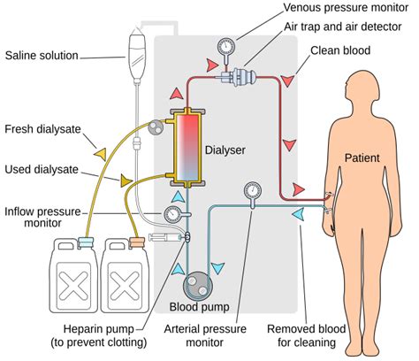 Dialysis Wikipedia