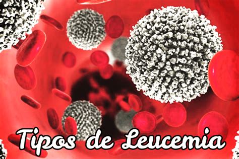 Tipos De Leucemia Tiposdepro