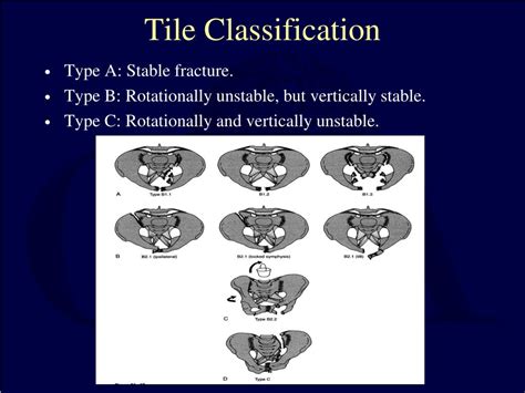 Ppt Anatomy Radiographic Evaluation And Classification Of Pelvic