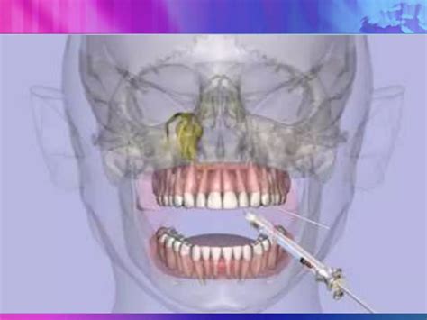 The Maxillary Nerve Pptx
