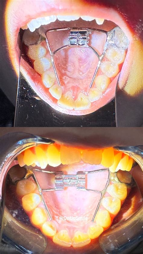 Opticsmile Did You Know That A Palatal Rapid Expander Rpe Can Do More Than Just Create Space