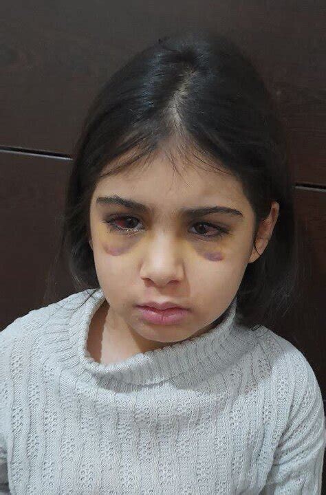 ضرب و شتم هولناک دختربچه ۹ ساله توسط نامادریعکس