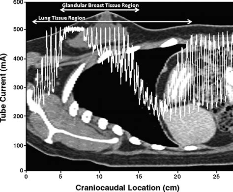 Tube Modulation Ct At John Hipple Blog