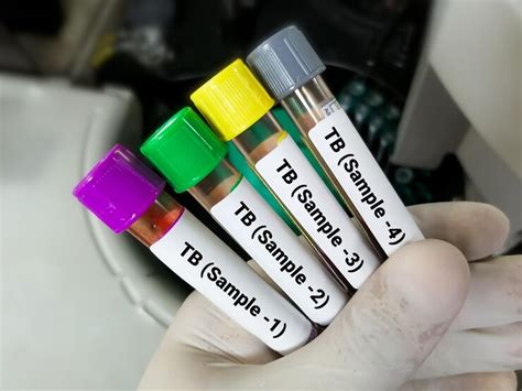 Muestras De Sangre Para La Prueba Tb Gold O Quantiferon Diagnóstico De