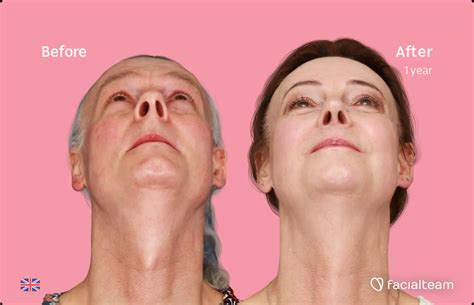 Tcontour® Over The Intraoral Technique In Adams Apple Reduction