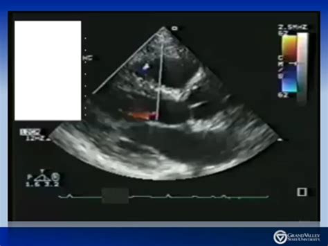 Peds Echo Ii Exam Iii Flashcards Quizlet