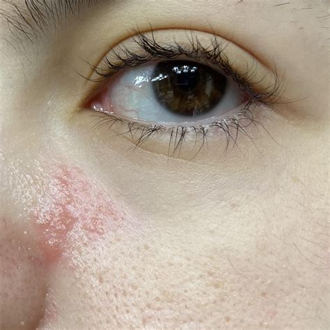 Woke Up With This Red Bumpy Texture Near Nose Not Sure What It Is Or What Caused It R