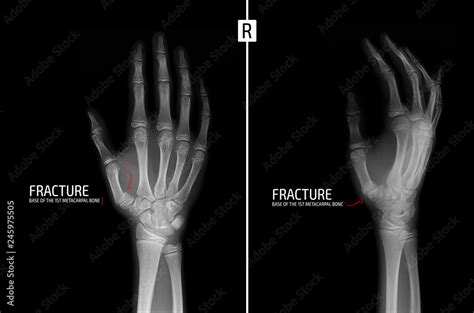X Ray Of The Hand Fracture Of The Base Of The 1st Metacarpal Bone Marker Stock Foto Adobe Stock X Ray Of The Hand Fracture Of The Base Of The 1st Metacarpal Bone Marker Stock Foto Adobe Stock