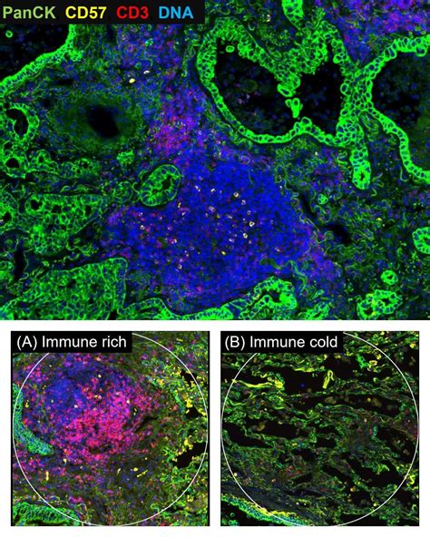 Nanostring Technologies Inc On Linkedin Lungcancer Biotech