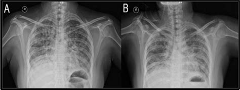 E A Plain Chest Radiograph Showing Bilateral Diffuse Reticulonodular Download Scientific