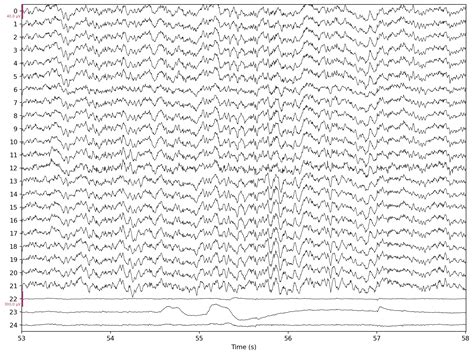 Removing Eye Activity From Eeg Via Regression Clemens Brunner