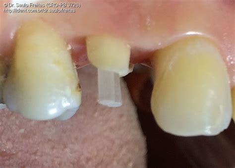 Coroa Metalo Cerâmica Com Núcleo De Fibra De Vidro Caso Clínico Ident